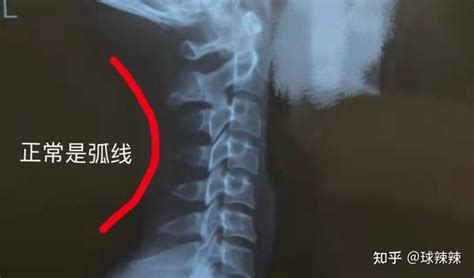 颈椎酸痛怎么办？缓解颈椎不适必看！ 知乎
