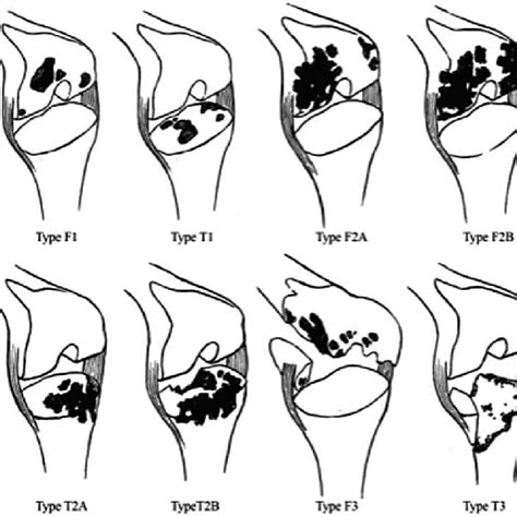 Anderson Orthopedic Research Institute Aori Classification Of Bone