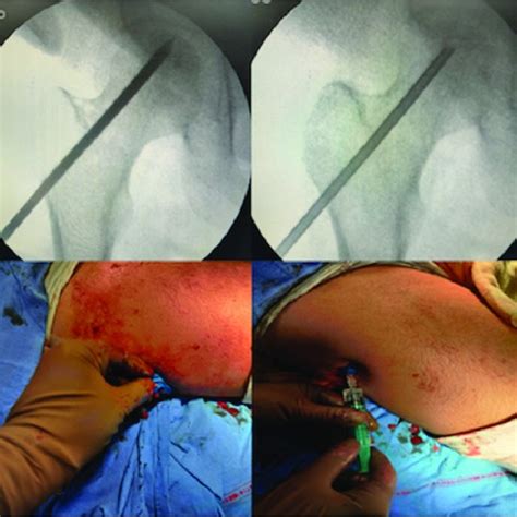 Technique Of Core Decompression Plus Instillation Of Ibandronate