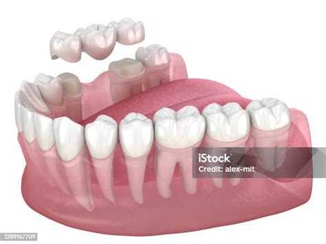 어금니와 소구 위에 3 개의 치아의 치과 다리 인간의 치아 치료의 의학적으로 정확한 3d 그림 건강관리와 의술에 대한 스톡 사진