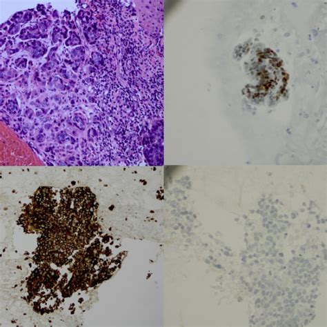Ultrasound Of The Thyroid Gland Shows A Diffusely Enlarged And