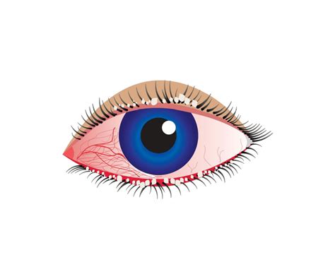 Blepharitis Symptoms Causes And Treatment