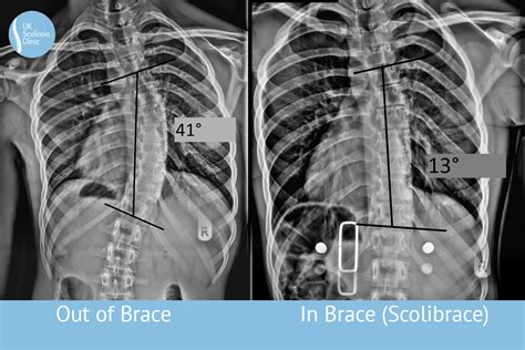 How To Choose A Scoliosis Brace Questions To Ask Your Practitioner