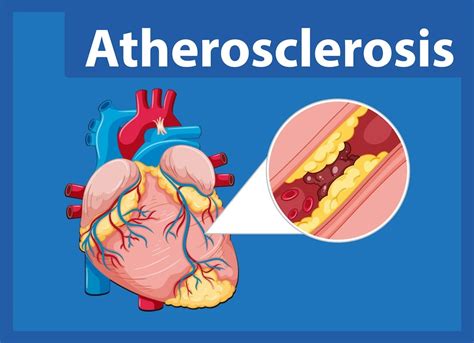 Free Vector Science Education Human Anatomy And Atherosclerosis