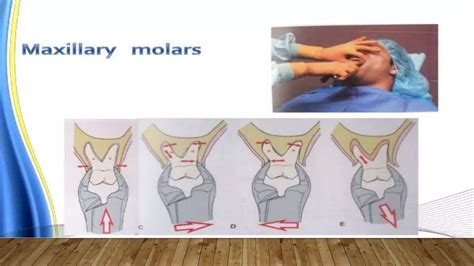 Extraction Of Primary Teeth Along With Permanent Teeth Pptx