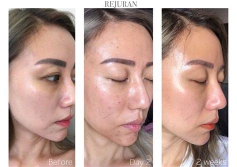 Rejuran Healer — Orange Medical Spa