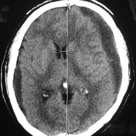 Ct Scan Showing Bilateral Subdural Collections Larger On The Right
