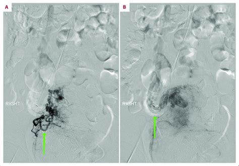 Right Uterine Angiogram Arterial A And Venous B Phase Demonstrating