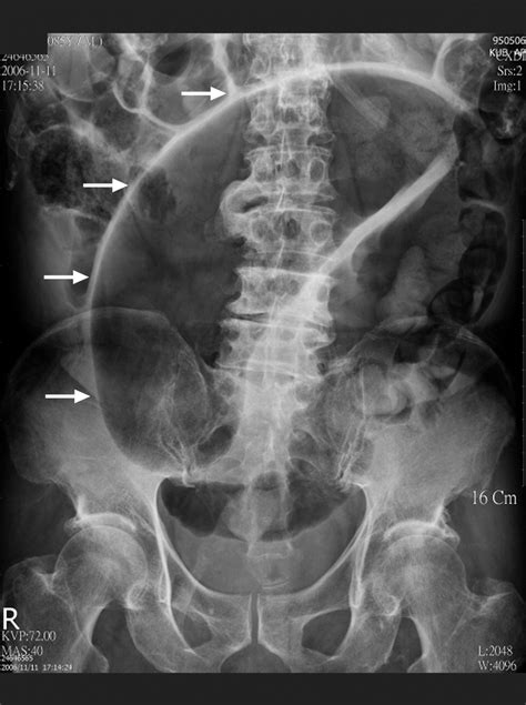 Sigmoid Volvulus Coffee Bean Sign