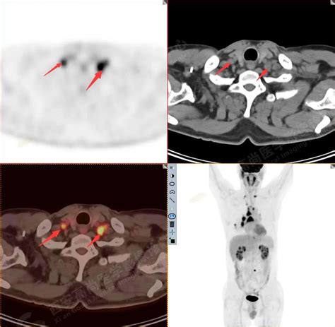 Pet Ct