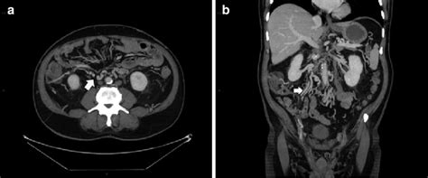 5 Collateral Pathway A 56 Year Old Patient With Ivc Leiomyosarcoma