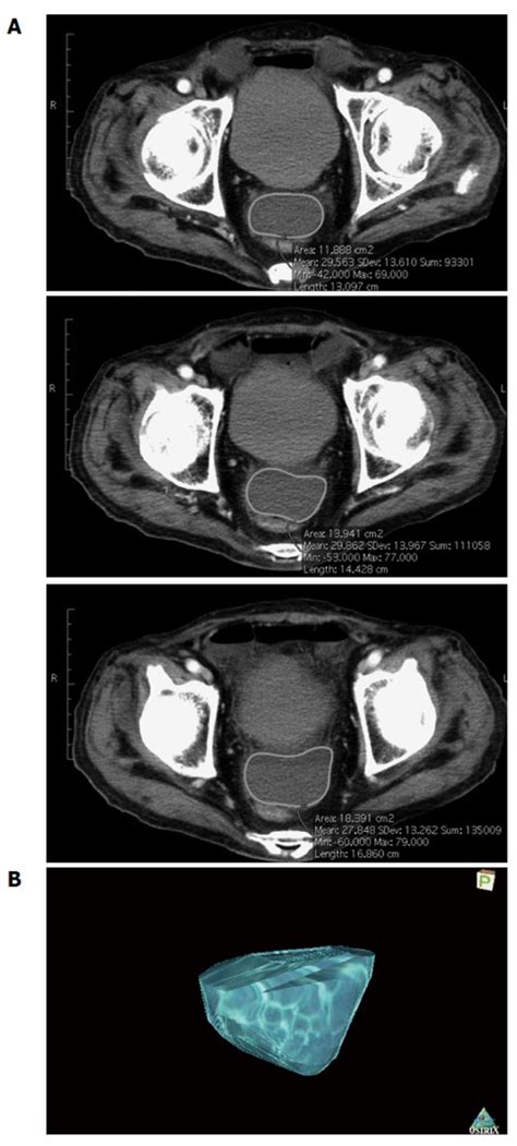 Computed Tomography Attenuation Values Of Ascites Are Helpful To