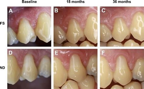 Preheated Thermoviscous Composite Resin Useful Option For Restoring