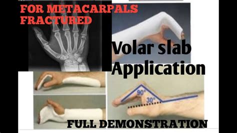 Metacarpal Fracture Cast Types At Irene Rayburn Blog