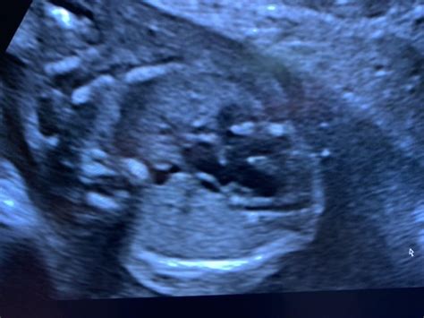 Tetralogy Of Fallot In A 23 Week Pregnancy Rultrasound