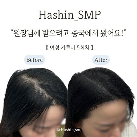 강남두피문신 헤어라인문신 논현두피문신 선릉두피문신 압구정두피문신 강남smp전문시술샵 하신smp Hashin Smp