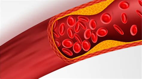 Penyebab Penyakit Aterosklerosis Ilmu