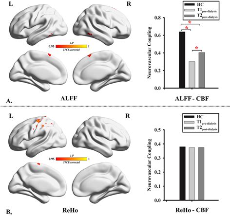 Between‐group Differences In Neurovascular Nv Coupling Patterns A