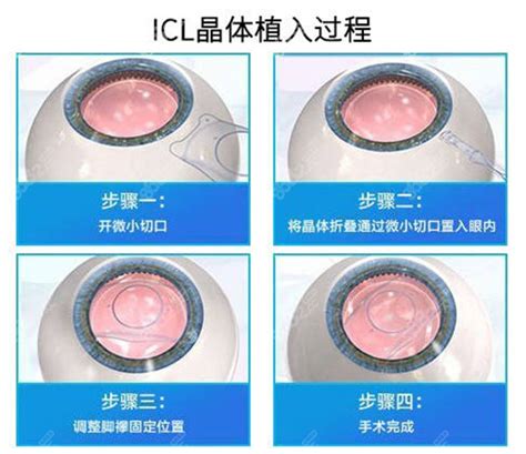郑州尖峰眼科医院哪个医生好做icl晶体植入可找刘保松院长近视眼矫正 8682整形网