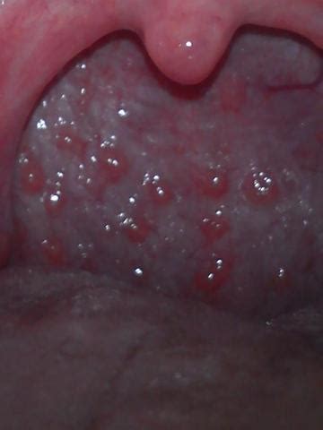 ᐅ Blasen im Hals Symptome Ursachen und Behandlungsmethoden