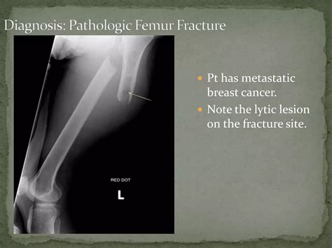 Pathologic Femur Fracture Ppt