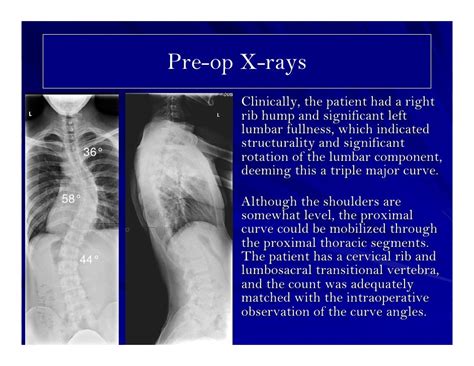 Case Review 21 Triple Curvature Adult Idiopathic Scoliosis