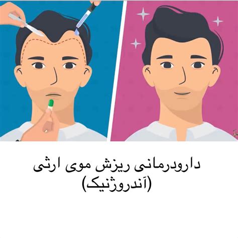 ‎داروخانه دکتر لاله شریف‎ ‎در پست قبلی راجع به الگوی ریزش موی
