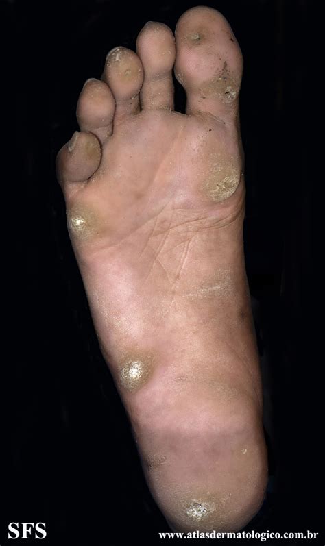 Palmoplantar Keratoderma Focal Keratoderma Nc Commons