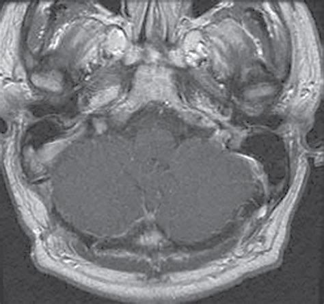 Vagal Schwannoma Postoperative Radiosurgery For Residual Tumor