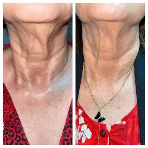 Conoce Los Hilos Tensores Pdo Dra Lietza Salud Y Belleza