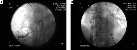 Cryoballoon Pulmonary Vein Isolation As A Standard Approach For Interventional Treatment Of