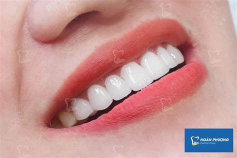 6 DÁng RĂng ĐẸp DẪn ĐẦu Xu HƯỚng NĂm 2025 Ngân Phượng
