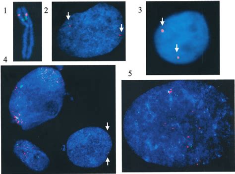 Fish In Interphase Nuclei From The Two Tumors Excised From Patients