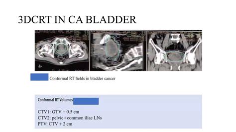 Ca Urinary Bladder Staging And Managment Pptx
