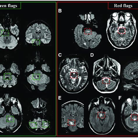 Characteristics Of Gadolinium Enhancing Multiple Sclerosis Lesions That