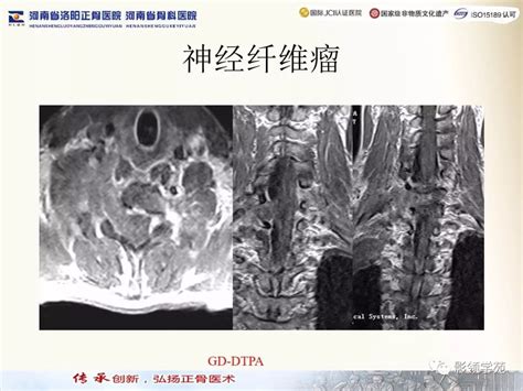 【经典】椎管内常见肿瘤mr诊断脊髓