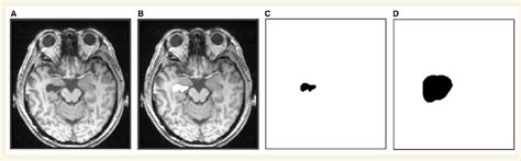 Figure 1 From Improved Cerebral Function In Mesial Temporal Lobe