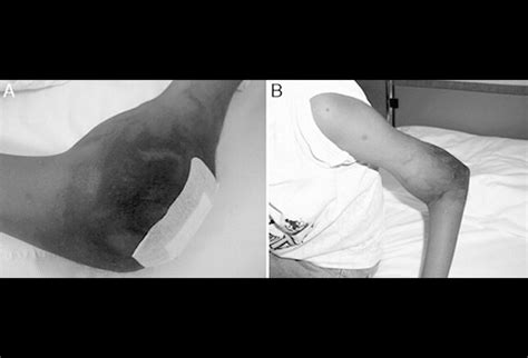 Osteosarcoma Chondrosarcoma And Ewing Sarcoma Bred In The Bone