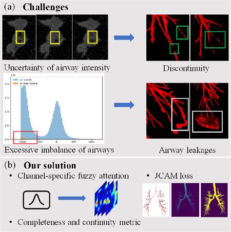 Figure 1 From Fuzzy Attention Neural Network To Tackle Discontinuity In Airway Segmentation
