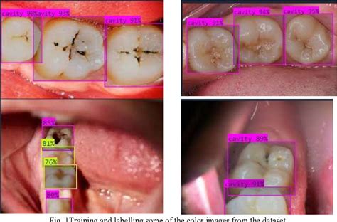 Figure 1 From Yolo V5 Deep Learning Model For Dental Problem Detection