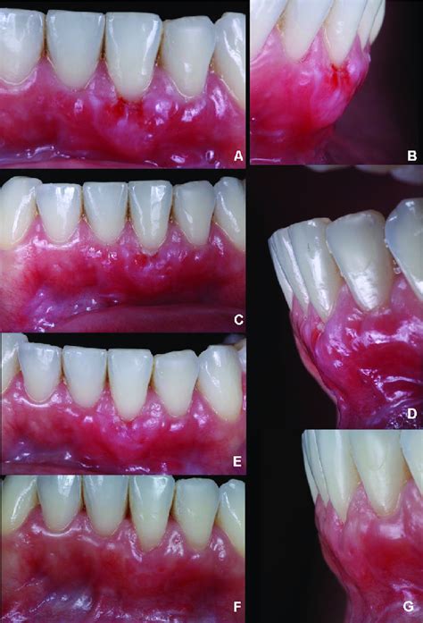 A And B Eleven Days After The Procedure C And D Thirteen Days After