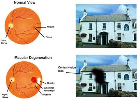 Macular Degeneration In Mumbai Id 7133531062