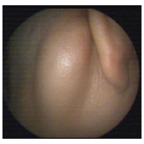 Right Postauricular Bulging Mass Which Is Asymptomatic Soft And