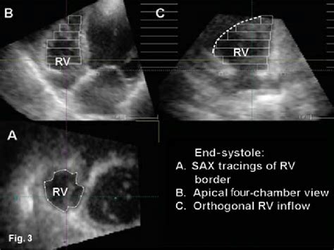 Manual Tracing Of Short Axis Slices A Of Right Ventricular Rv Download Scientific Diagram