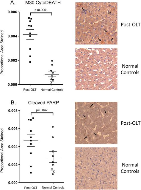 Increased Hepatocyte Apoptosis Is Seen After Liver Transplantation On Download Scientific