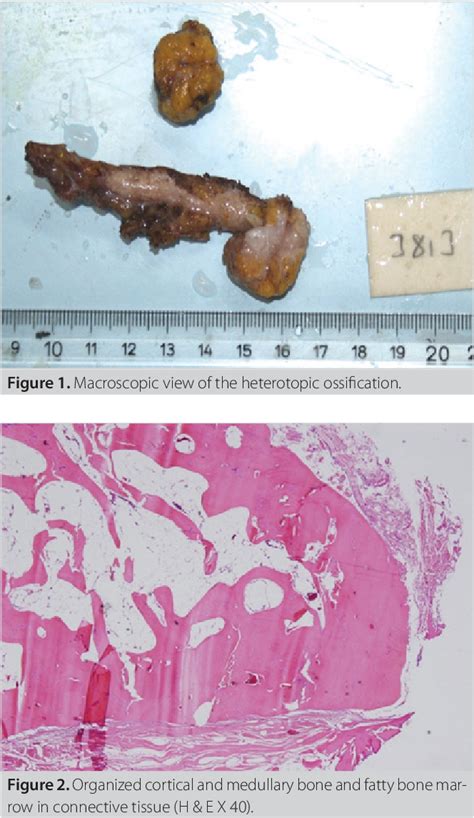 Figure 2 From Heterotopic Ossification Of The Anterior Abdominal Wall Semantic Scholar