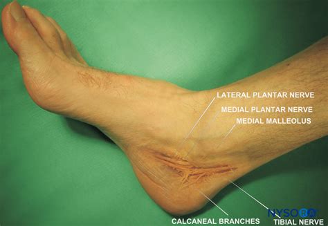 Regional Anesthesia Tibial Nerve At The Level Of The Ankle Nysora