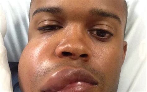 Fractured Cheekbone Fracture Treatment