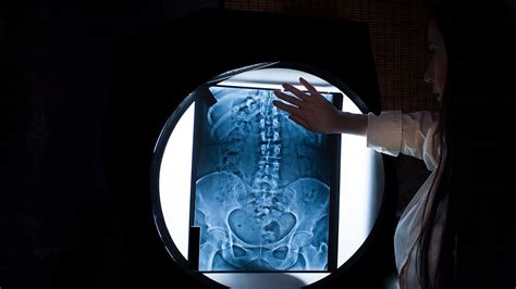 Congenital Scoliosis What It Is And How Its Treated