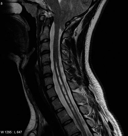 Syrinx Radiology Reference Article